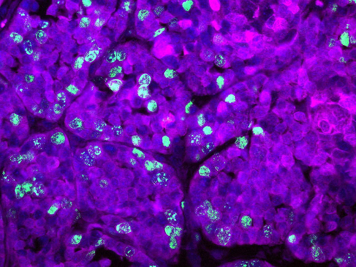 Improved Method Boosts Tumor Target Detection in Biopsies | Mirage News