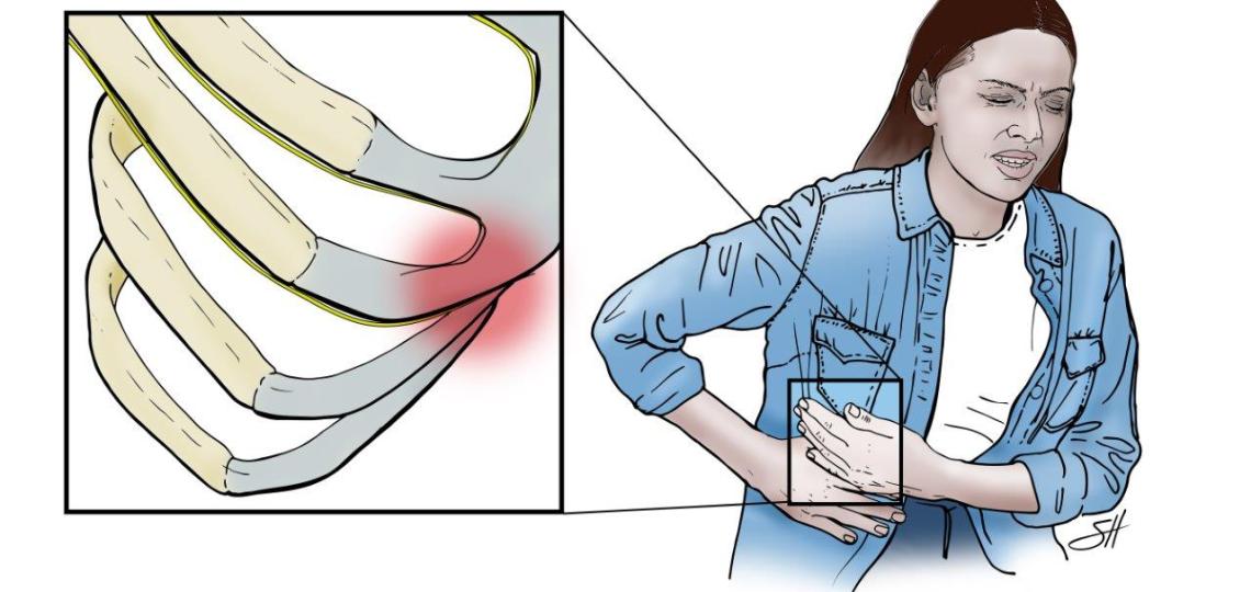 Slipping Rib Syndrome | Baylor Medicine