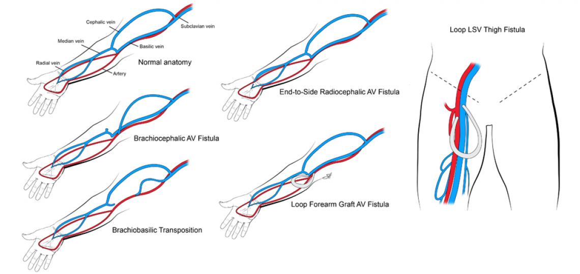 Dialysis Fistula Diagram Dialysis Fistula Diagram