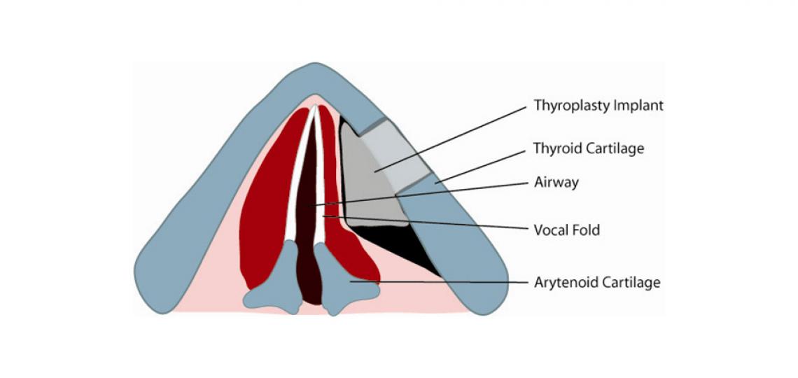 Vocal Fold Paralysis