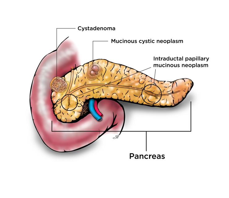 Mucinous Cyst On Pancreas