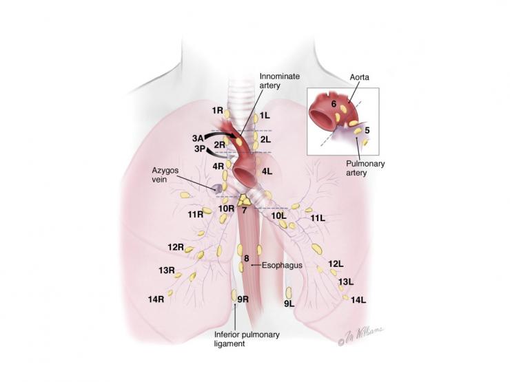 Radical Lymphadenectomy | Baylor Medicine Radical Lymphadenectomy | Baylor Medicine